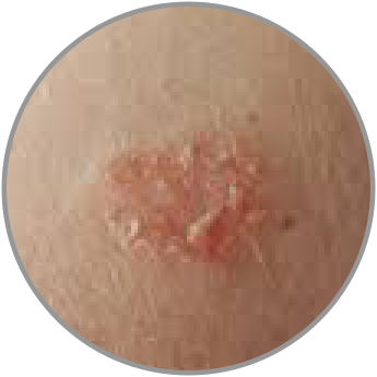 Eczema Treatment in Crest Hill & Naperville | Premier Dermatology