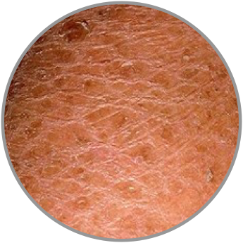 Eczema Treatment in Crest Hill & Naperville | Premier Dermatology