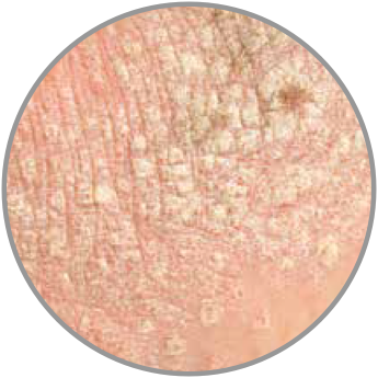 Eczema Treatment in Crest Hill & Naperville | Premier Dermatology