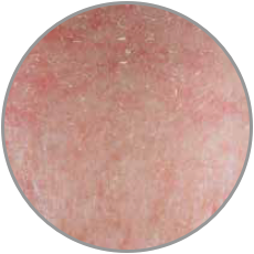 Eczema Treatment in Crest Hill & Naperville | Premier Dermatology