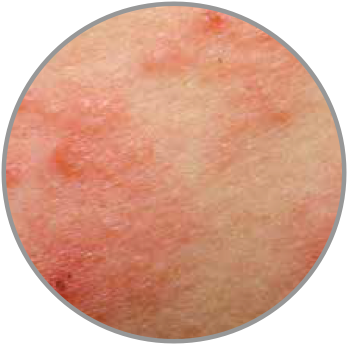 Eczema Treatment in Crest Hill & Naperville | Premier Dermatology